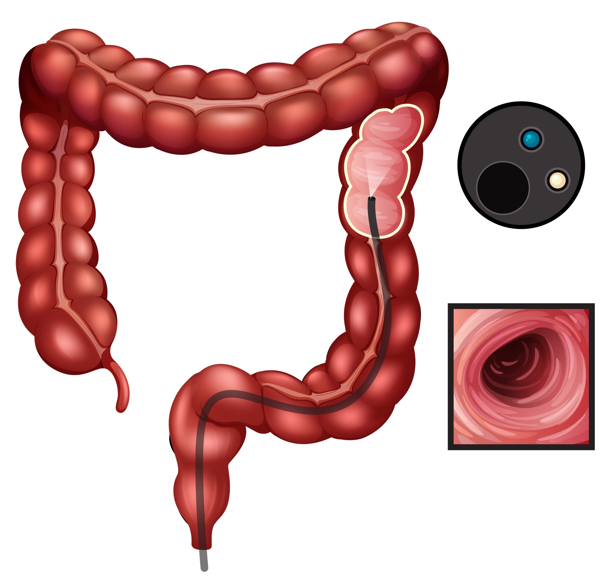 Colonoscopia – Hospital Imaculada Conceição